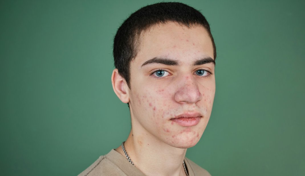 Roaccutane and other acne treatments | The Mix
