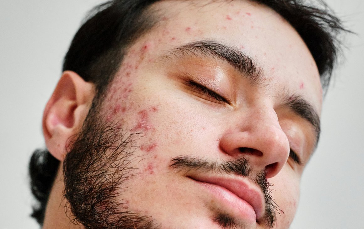 Roaccutane and other acne treatments | The Mix